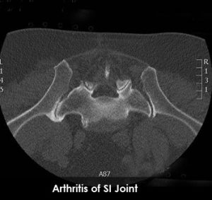 Si Joint | Pelvis and Hips